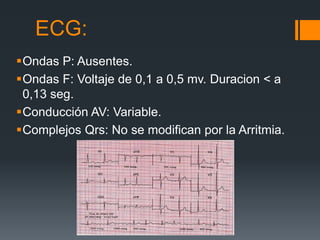 Taquiarritmias qrs angosto | PPTX