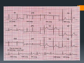 Taquiarritmias qrs angosto | PPTX