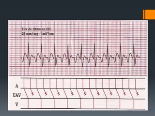 Taquiarritmias qrs angosto | PPTX