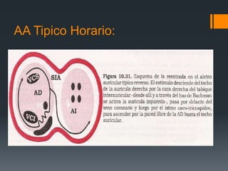 Taquiarritmias qrs angosto | PPTX