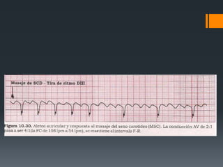 Taquiarritmias qrs angosto | PPTX
