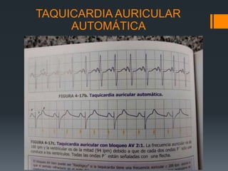 Taquiarritmias qrs angosto | PPTX