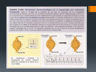 Taquiarritmias qrs angosto | PPTX