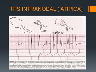 Taquiarritmias qrs angosto | PPTX