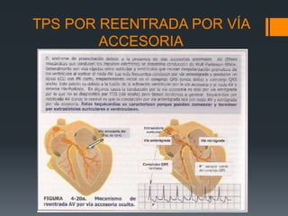 Taquiarritmias qrs angosto | PPTX
