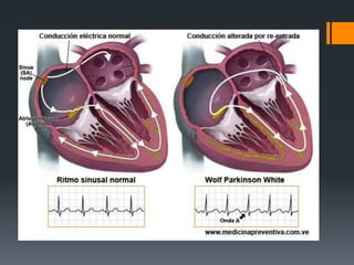 Taquiarritmias qrs angosto | PPTX