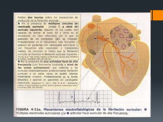 Taquiarritmias qrs angosto | PPTX