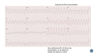 Taquicardia de complejo QRS ancho 2021.pptx
