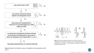 Taquicardia de complejo QRS ancho 2021.pptx