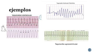 Taquicardia de complejo QRS ancho 2021.pptx