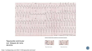 Taquicardia de complejo QRS ancho 2021.pptx