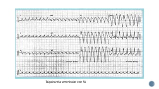 Taquicardia de complejo QRS ancho 2021.pptx
