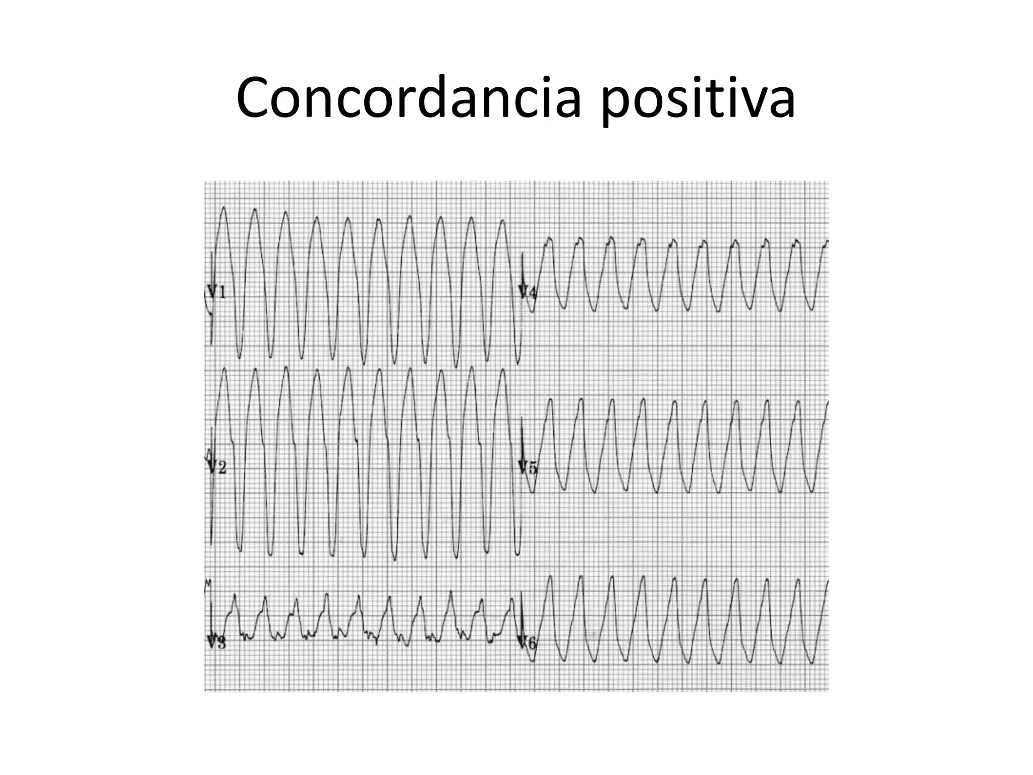 TAQUICARDIA DE QRS ANCHO, ARRITMIAS VENTRICULARES.pptx