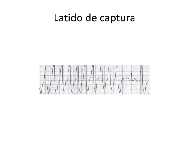 TAQUICARDIA DE QRS ANCHO, ARRITMIAS VENTRICULARES.pptx