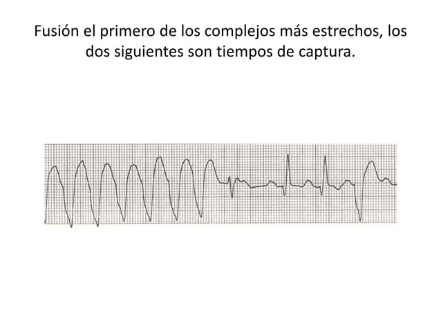 TAQUICARDIA DE QRS ANCHO, ARRITMIAS VENTRICULARES.pptx