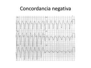 TAQUICARDIA DE QRS ANCHO, ARRITMIAS VENTRICULARES.pptx