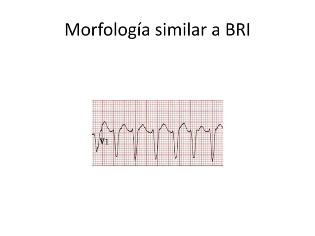 TAQUICARDIA DE QRS ANCHO, ARRITMIAS VENTRICULARES.pptx