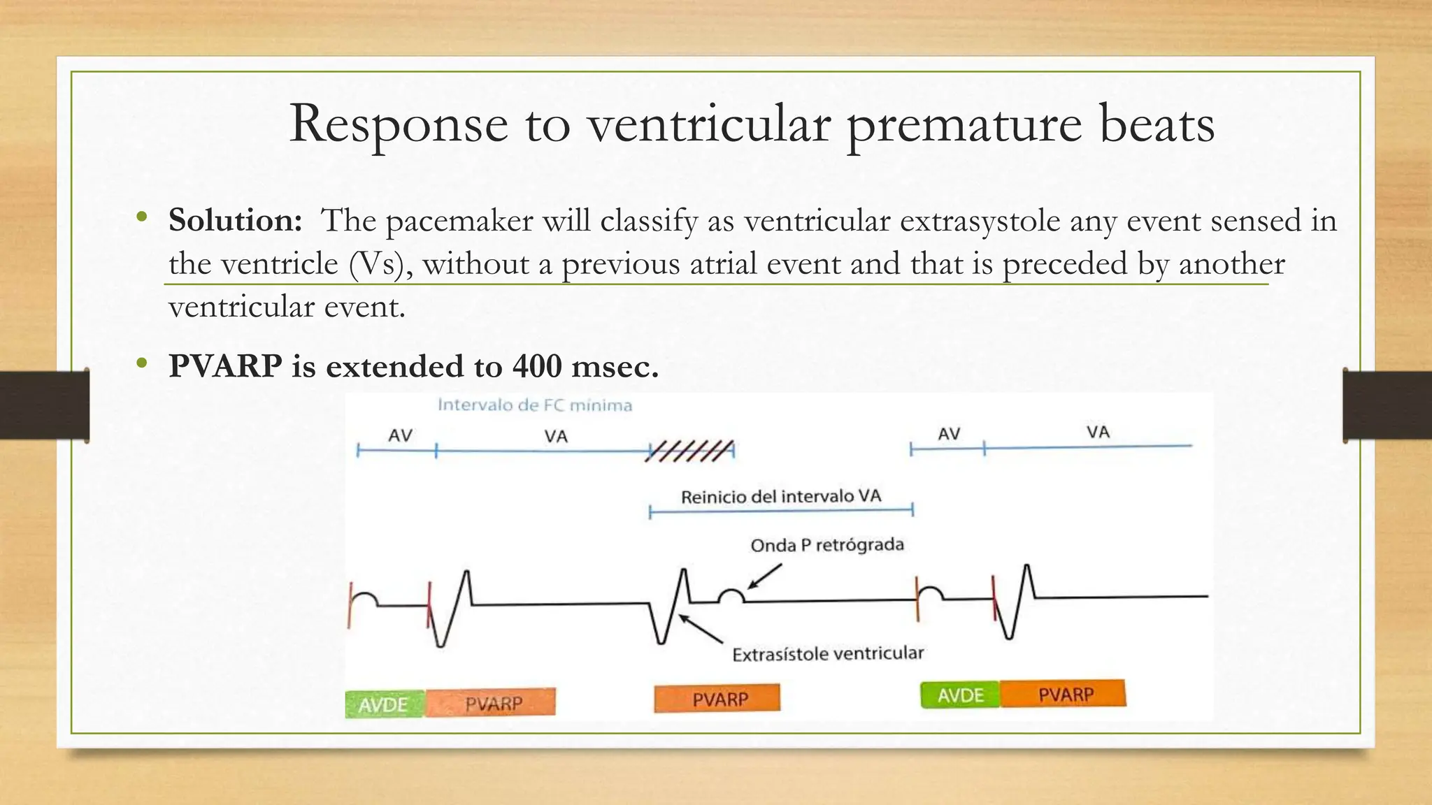 Taquicardia por marcapasos. pptx.pptx
