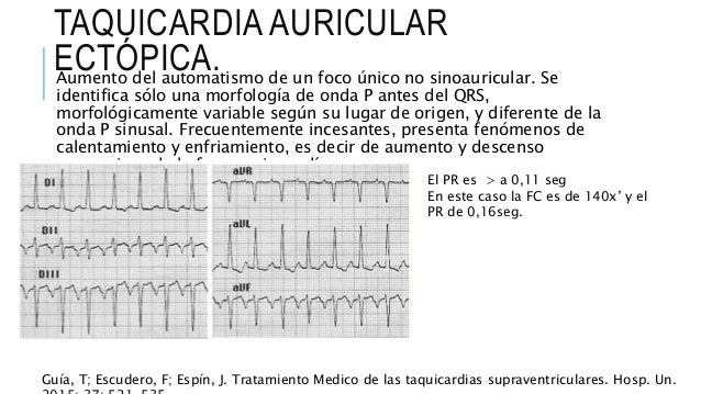 Taquicardias superventriculares y ventriculares