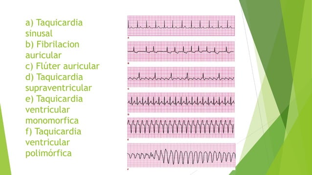 TAQUICARDIA SUPRAVENTRICULAR manejo y vigilancia | PPTX | Heart and ...