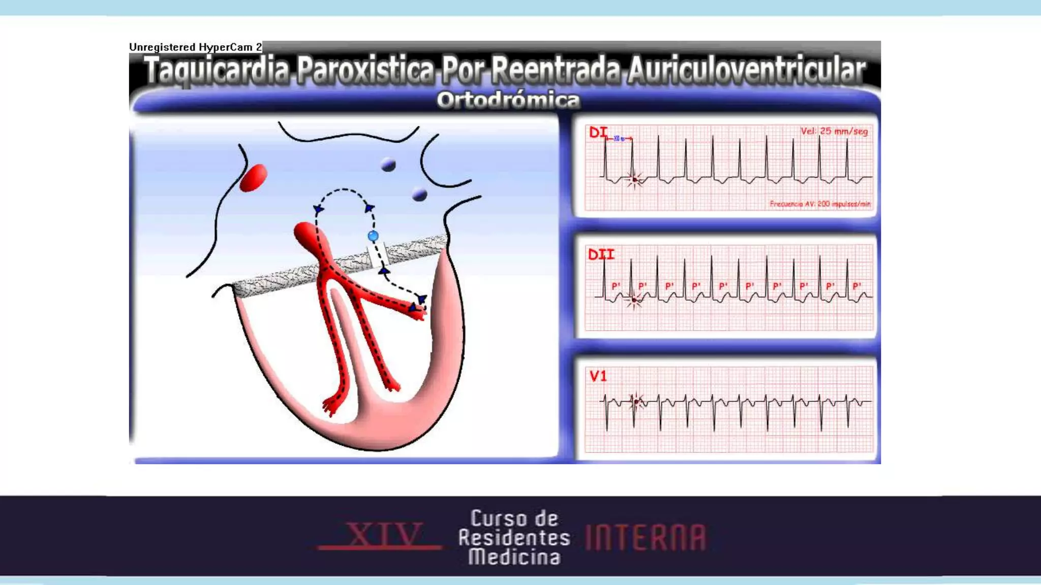 Taquicardia supraventricular | PPTX