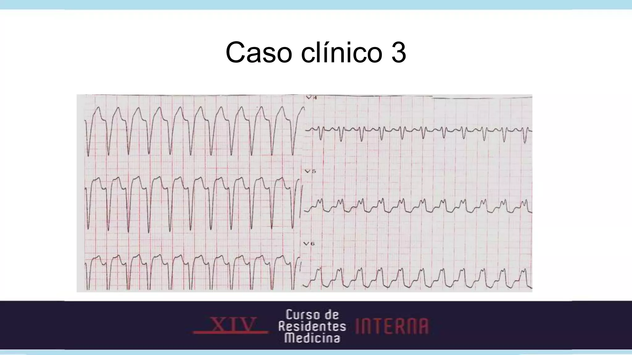 Taquicardia supraventricular | PPTX