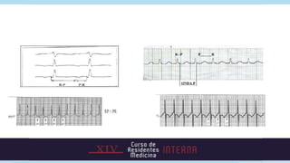 Taquicardia supraventricular | PPTX