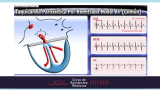 Taquicardia supraventricular | PPTX
