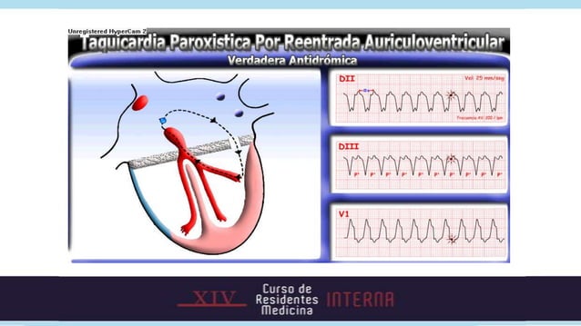Taquicardia supraventricular | PPTX