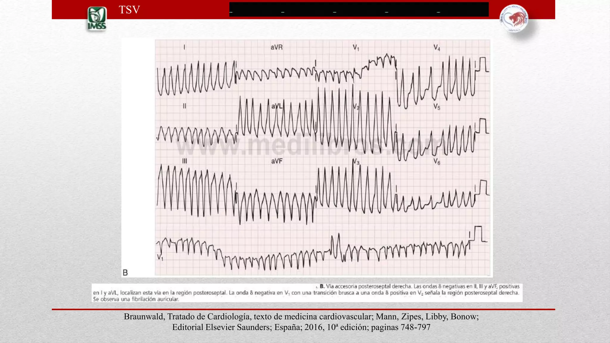 Taquicardia supraventricular Parte I | PPTX