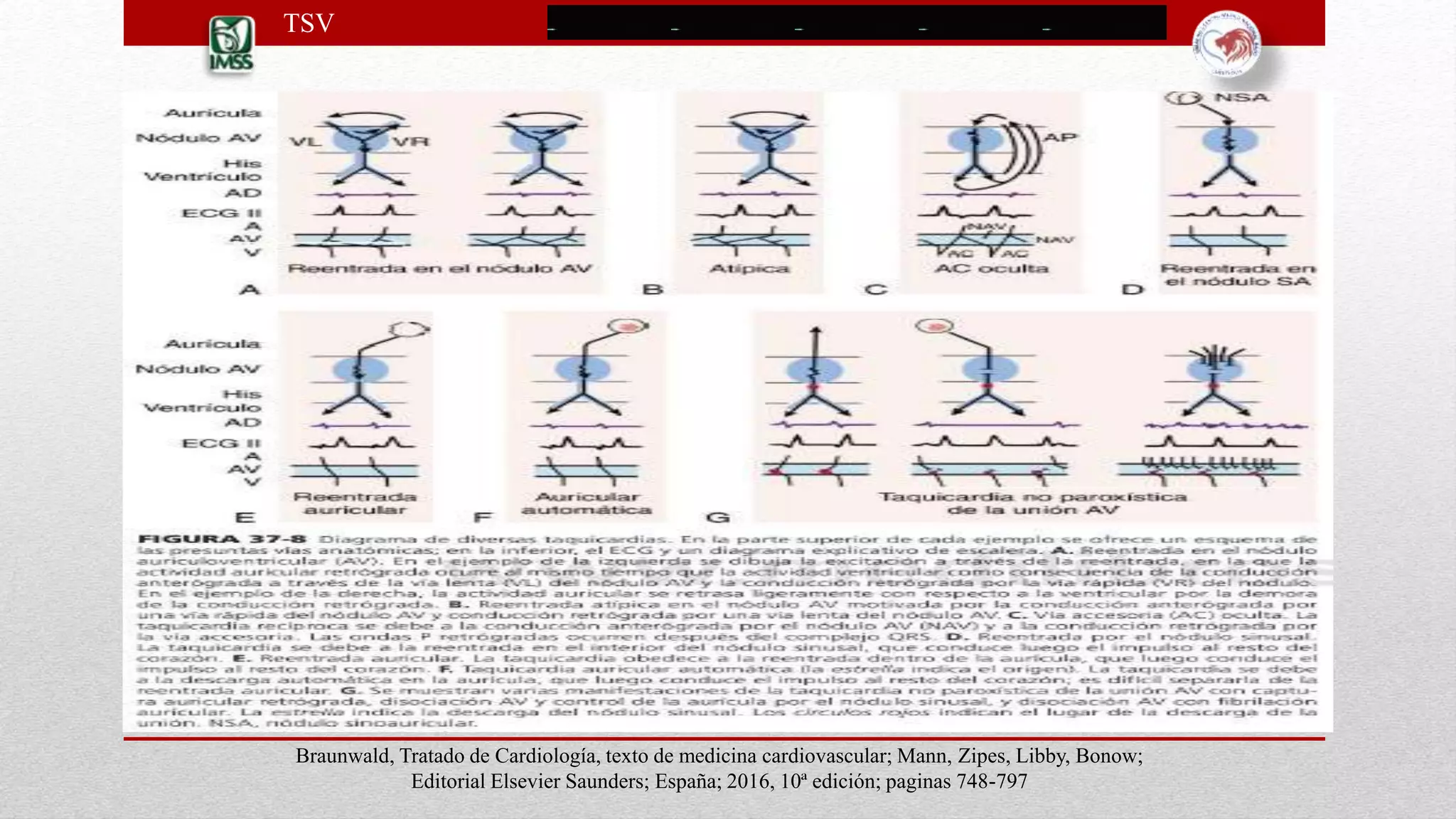 Taquicardia supraventricular Parte I | PPTX