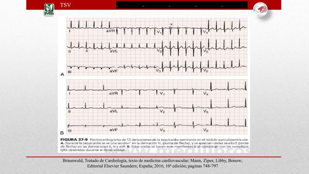 Taquicardia supraventricular Parte I | PPTX