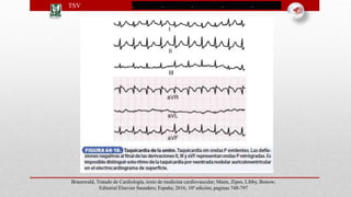 Taquicardia supraventricular Parte I | PPTX