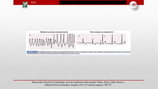 Taquicardia supraventricular Parte I | PPTX