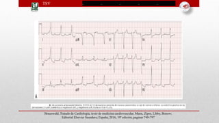 Taquicardia supraventricular Parte I | PPTX