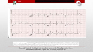 Taquicardia supraventricular Parte I | PPTX