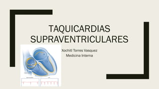 taquicardia supraventricular tipos causas | PPTX
