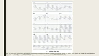 taquicardia supraventricular tipos causas | PPTX