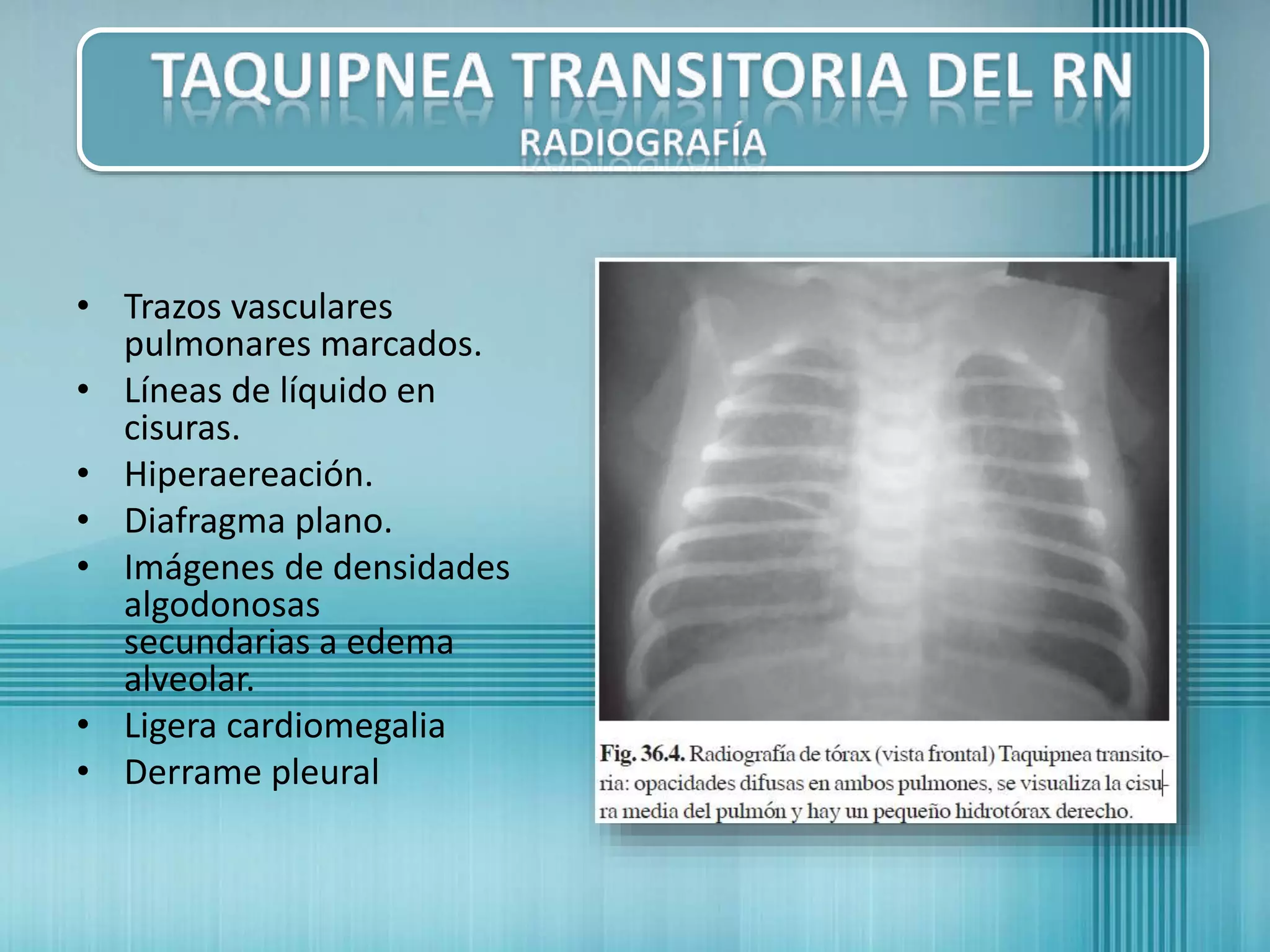 Taquipnea transitoria del recien nacido (TTRN) | PPTX