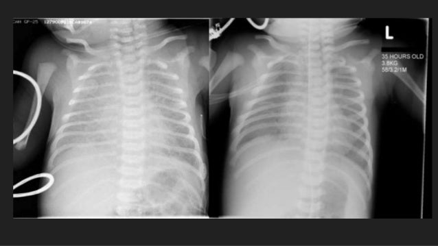 Taquipnea transitoria del recién nacido (ttrn)