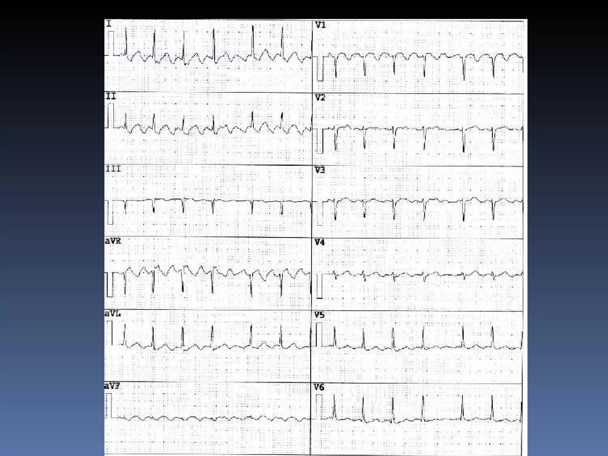 TAQUICARDIA SUPRAVENTRICULAR | PPT
