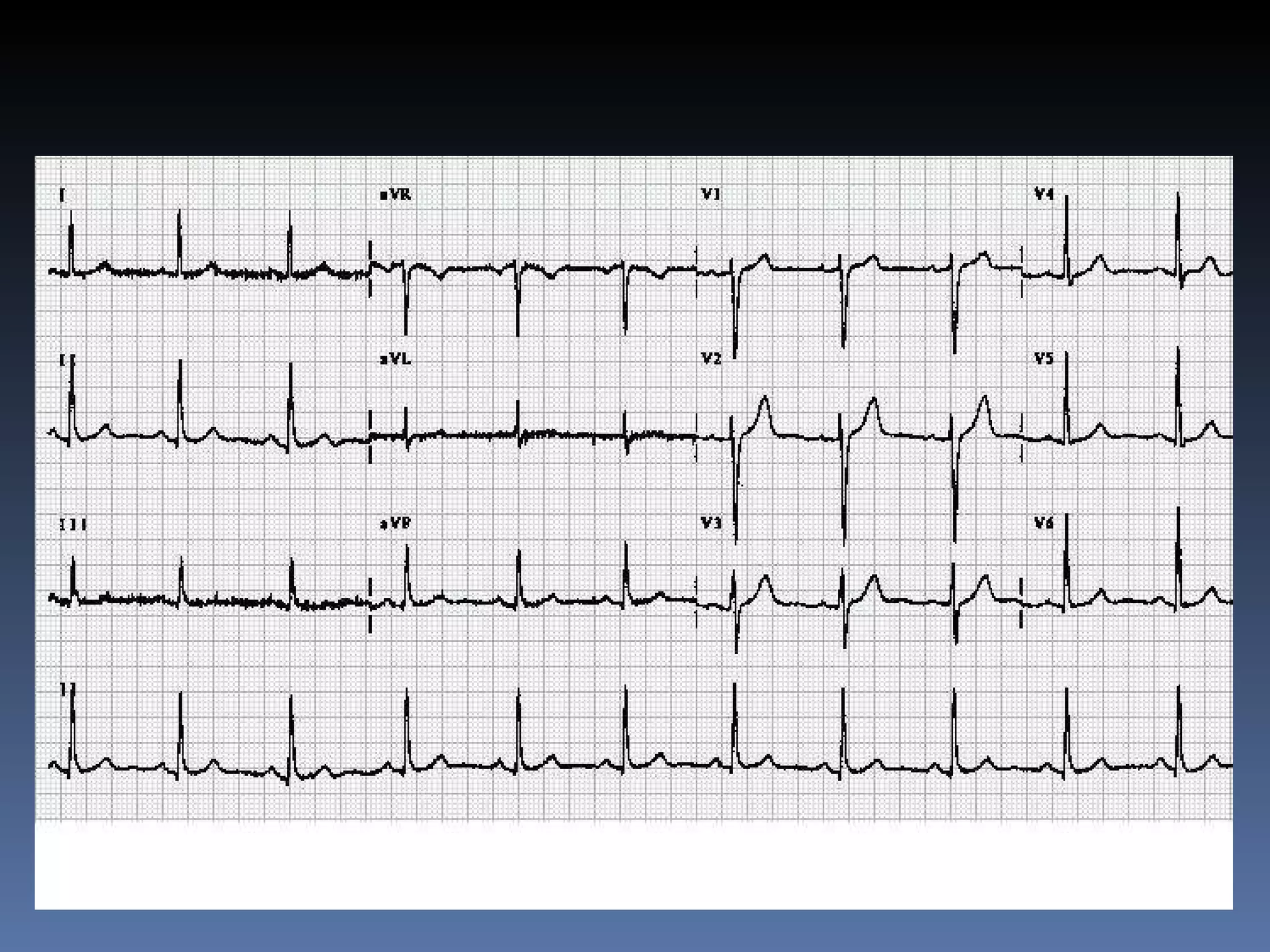 TAQUICARDIA SUPRAVENTRICULAR | PPT