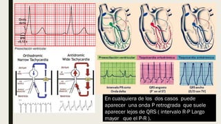 TAQUICARDIA SUPRAVENTRICULAR URGENCIAS MEDICO QUIRUGICAS | PPTX