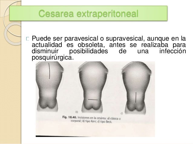 Tarea33 jimr cesarea