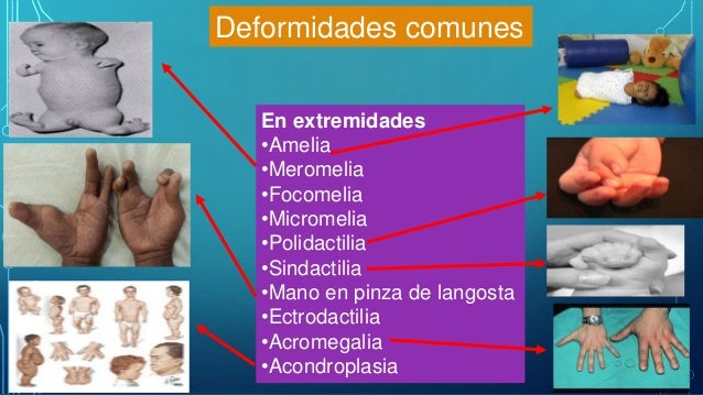 Tarea9. anomalias y malformaciones geneticas.Eudys.Farfan.