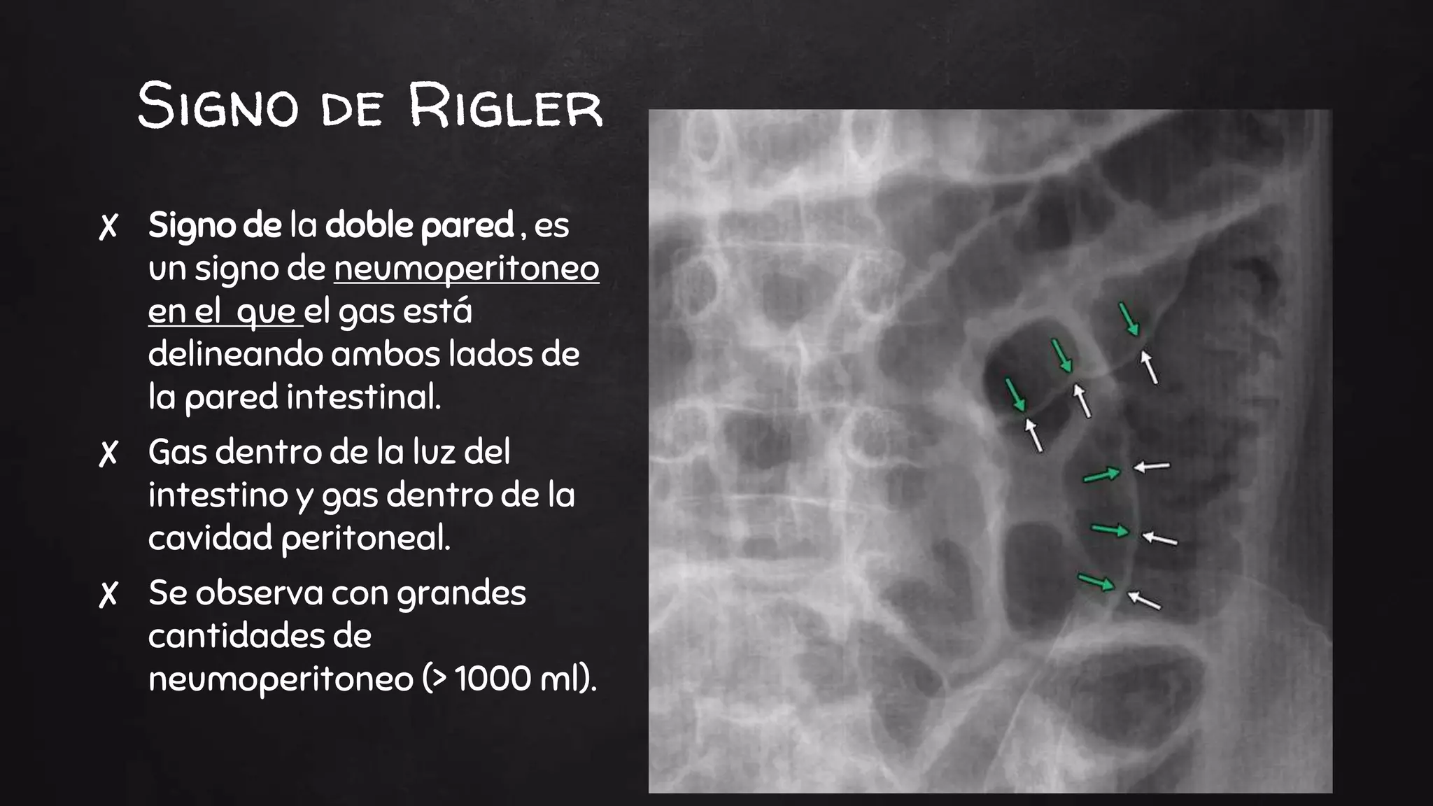 TAREA NEUMOBILIA NEUMATOSIS PROTAL RIGLER.pptx | Medical Health