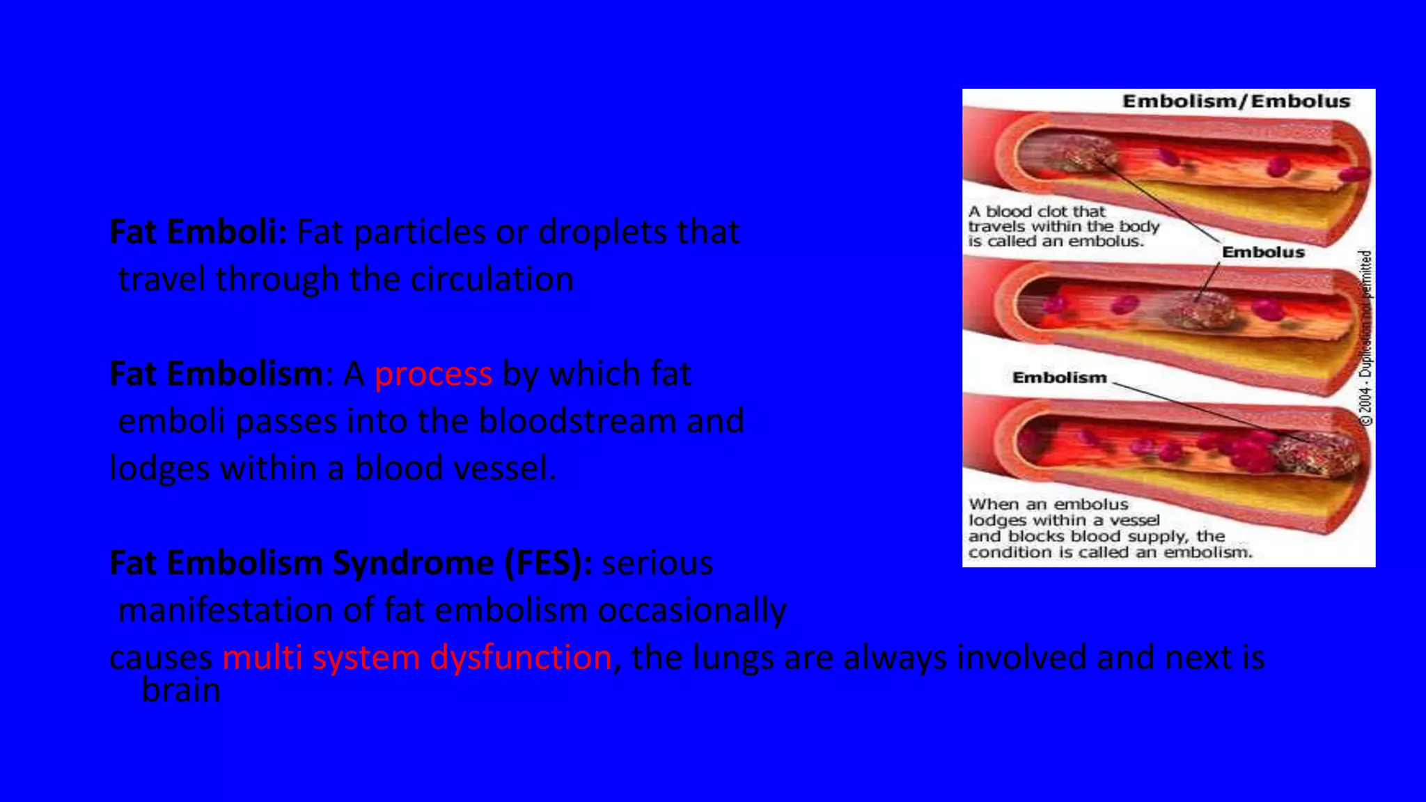 Cerebral Fat Embolism in ICU | PDF