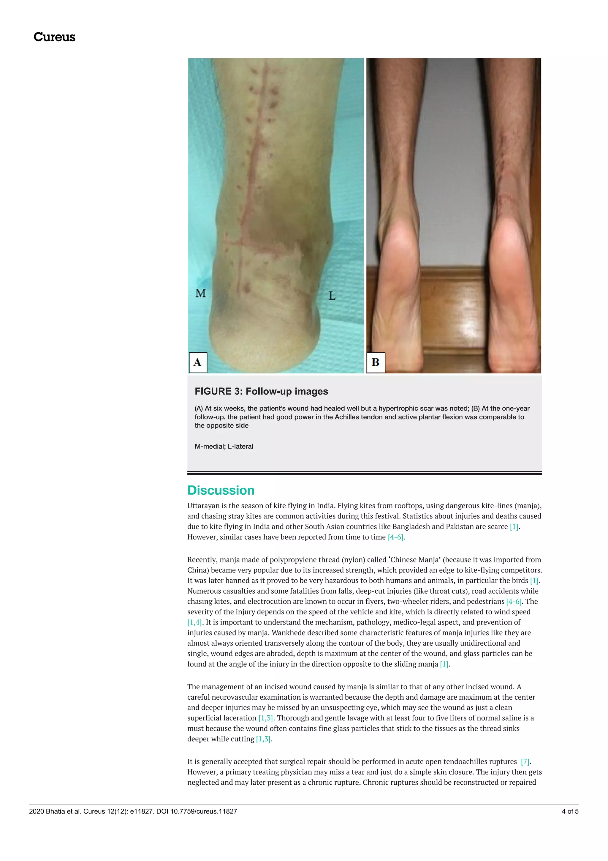 Kite String Injury Causing a Complete Tear of the Tendoachilles | PDF