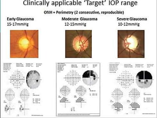 Target IOP Lt Col Rashed | PPTX