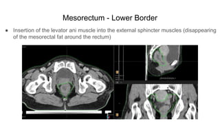TARGET DELINEATION IN RECTUM CANCER BY DR KANHU | PPTX